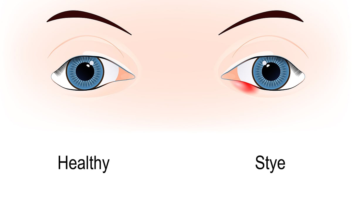 STYE Infection Pain Relief In Hindi: स्टाई के दर्द से कैसे पाएं आराम ...
