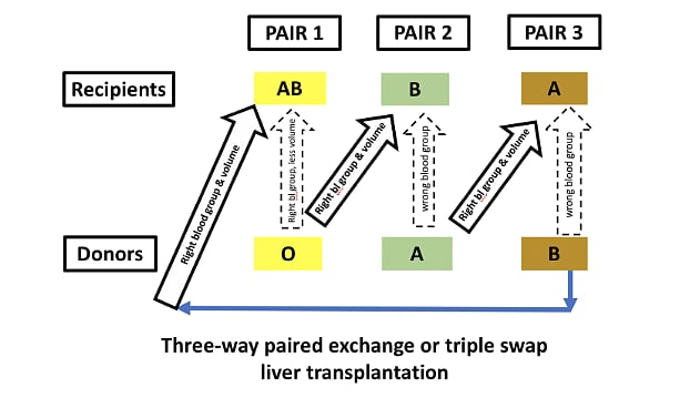 World Liver Day: India’s First Successful Three-Way Swap Liver ...