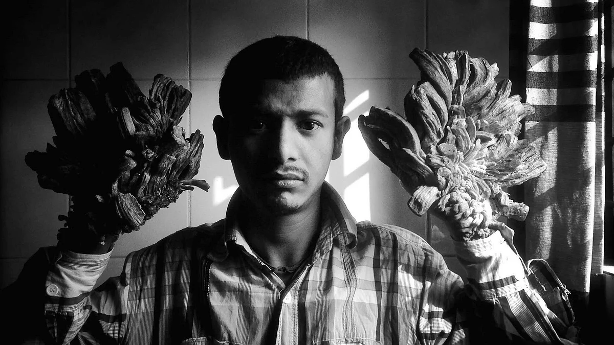 Bangladeshs ‘tree Man Abul Bajandar Back In Hospital