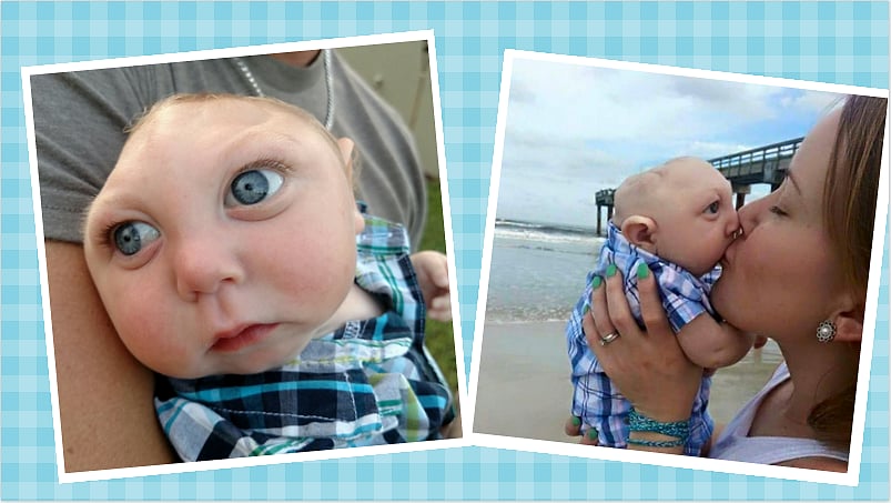 Baby Born With Half a Skull Celebrates His First Birthday