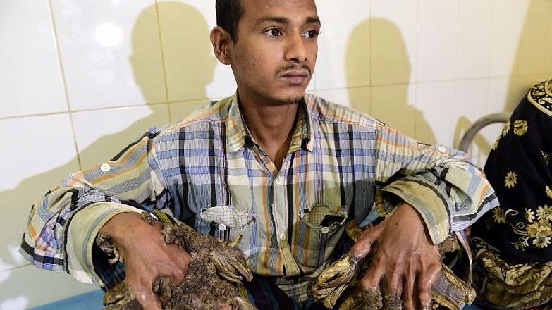 After a Decade and 16 Surgeries, Bangladesh’s ‘Tree Man’ Has Hope