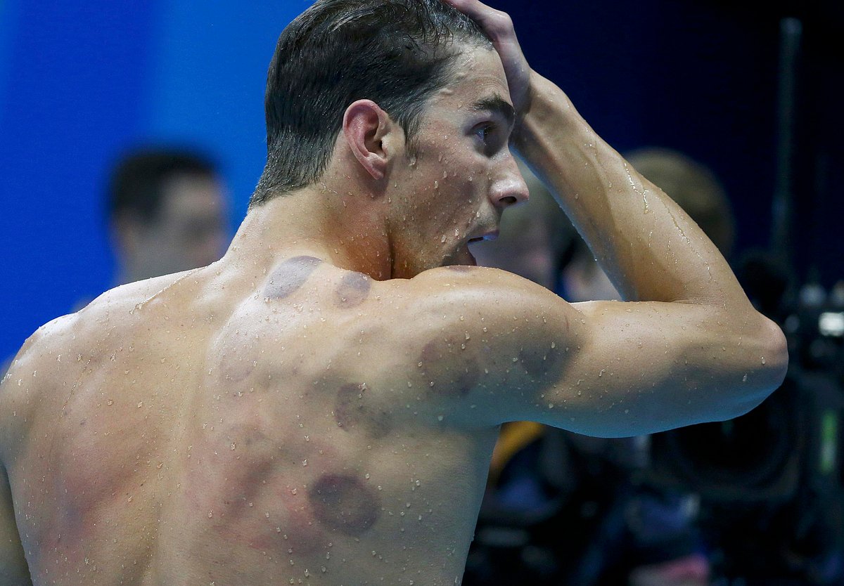 Michael Phelps Uses it, Reflexology & Cupping Gaining Popularity
