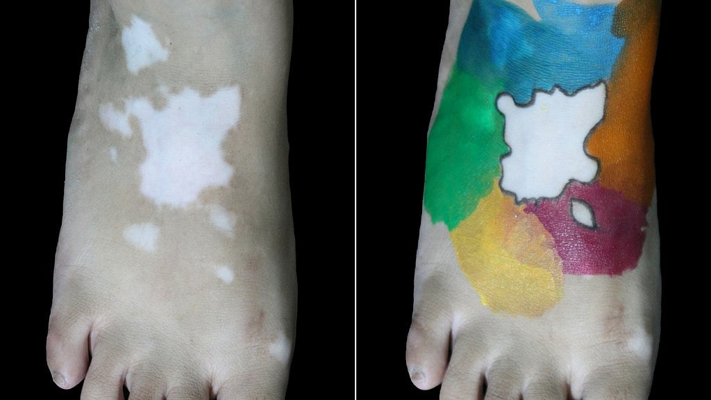 ‘Vitiligo Queen’ Fights Bullies By Turning Her Body Into Art