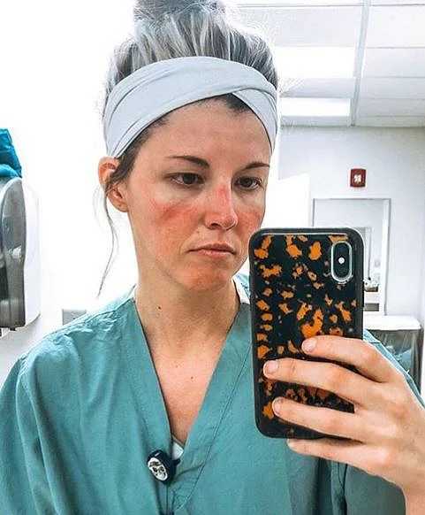 Rash, Sweat, Bruises: Wearing PPE for Hours Causing Skin Infection