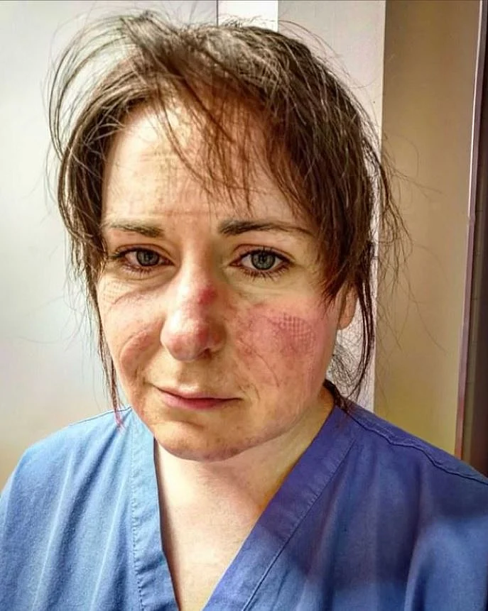 Rash, Sweat, Bruises: Wearing PPE for Hours Causing Skin Infection