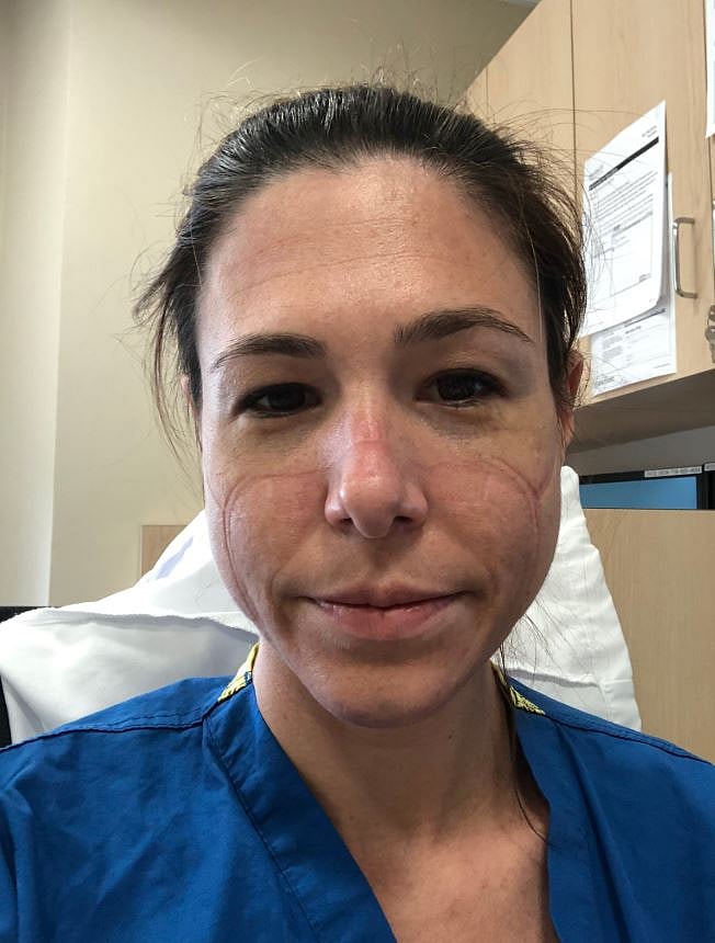 Rash, Sweat, Bruises: Wearing PPE for Hours Causing Skin Infection