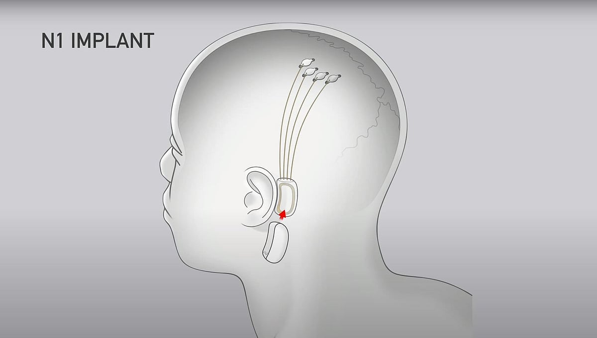 What is Neuralink & How Does It Work?