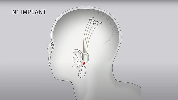 What is Neuralink & How Does It Work?