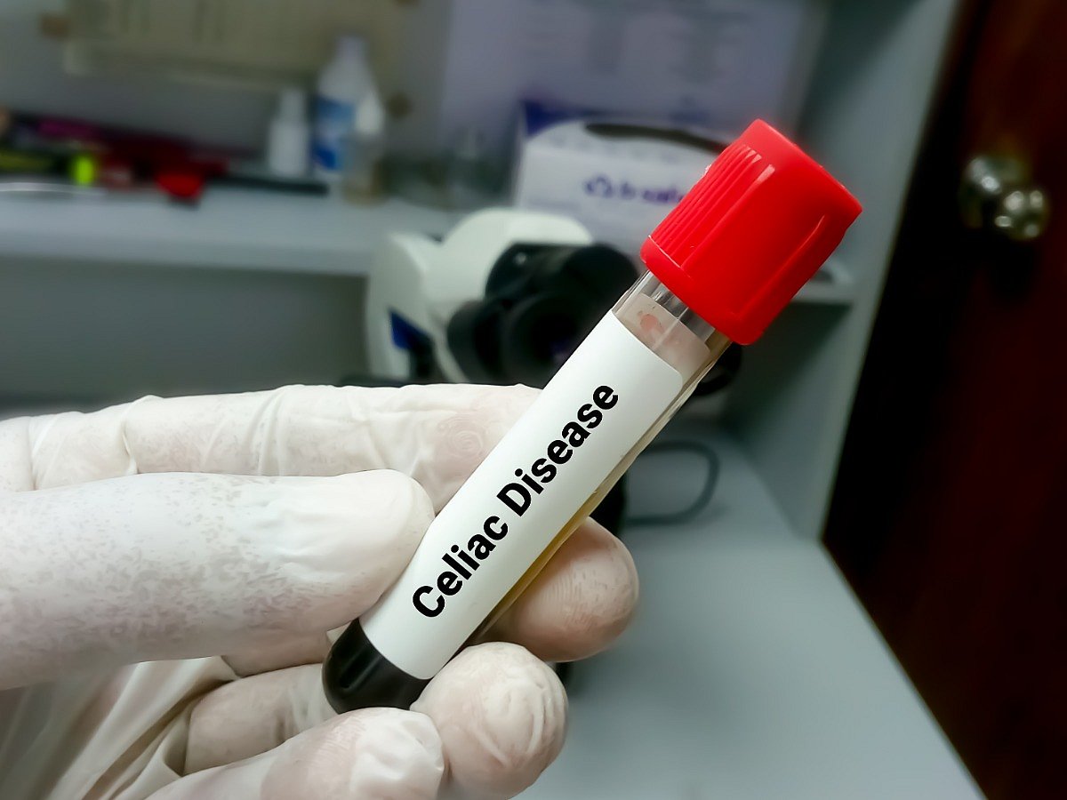 Celiac Disease: Causes, Symptoms, Diagnosis and Treatment