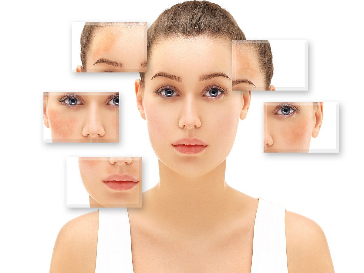 Melasma: Types, Causes, Symptoms, Diagnosis and Treatment