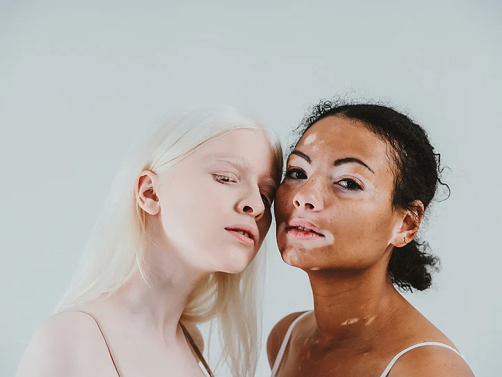 International Albinism Awareness Day 2022: Theme, History, and Significance