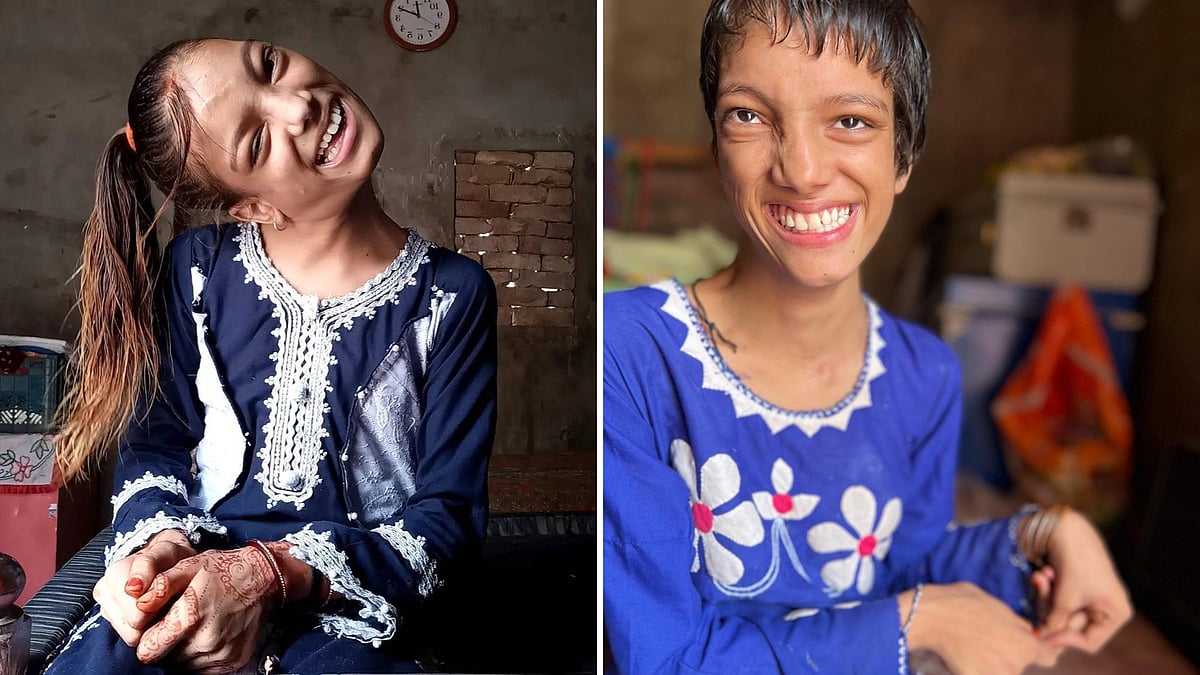 Thanks to Delhi Doctor, Girl With a 90° Bent Neck Treated Successfully ...