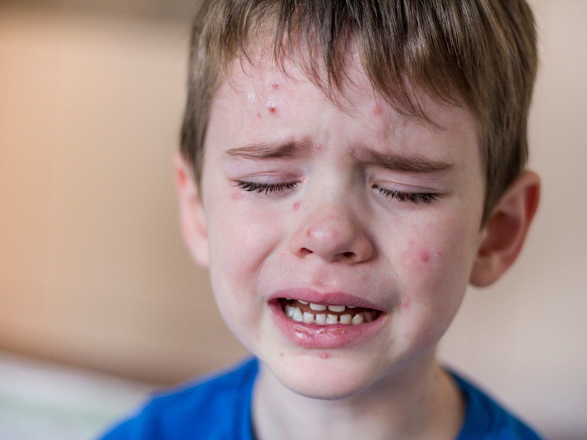 Measles: Symptoms, Causes, Diagnosis and Treatment