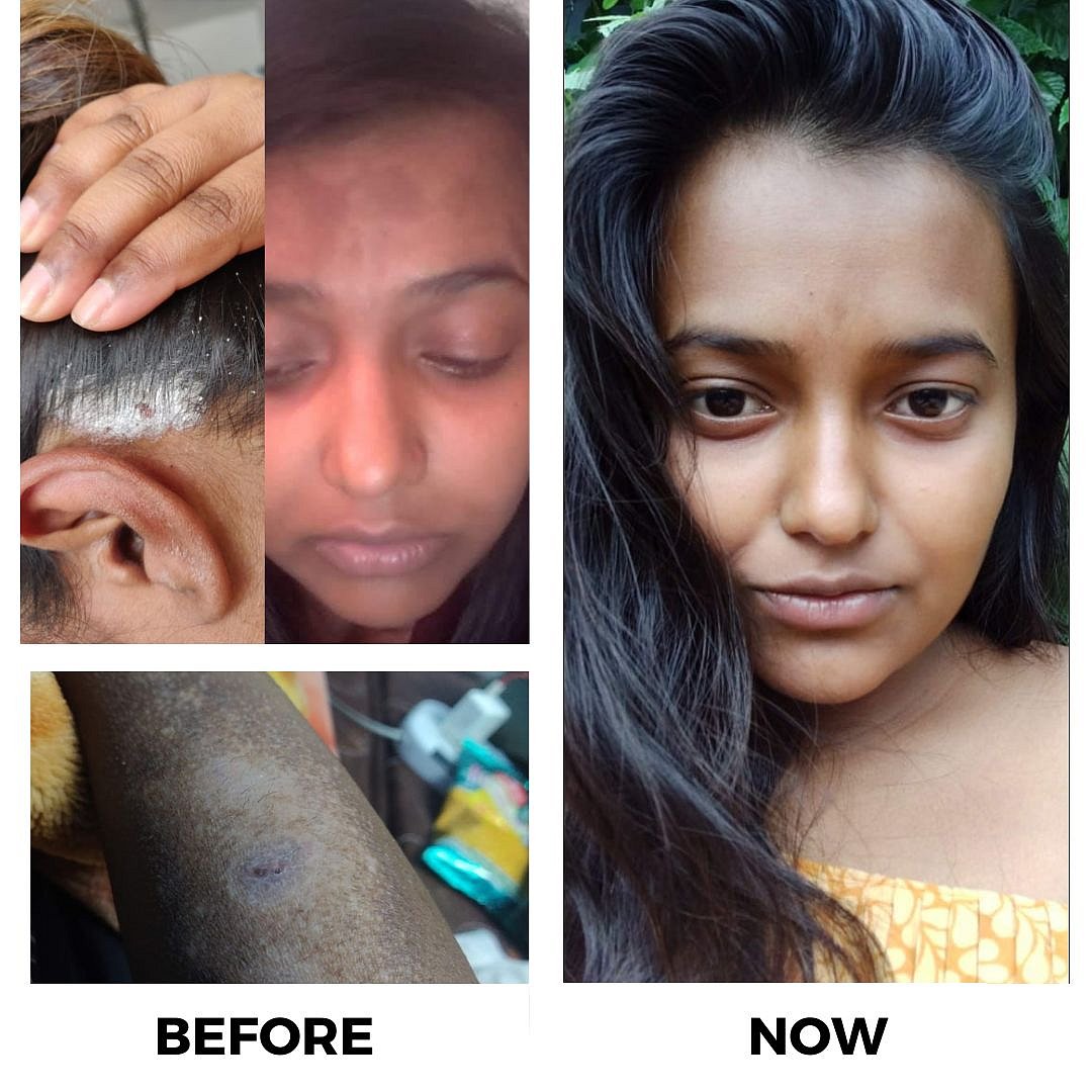 Skin Diseases & Mental Health: Severe Skin Conditions Can Cause Anxiety ...