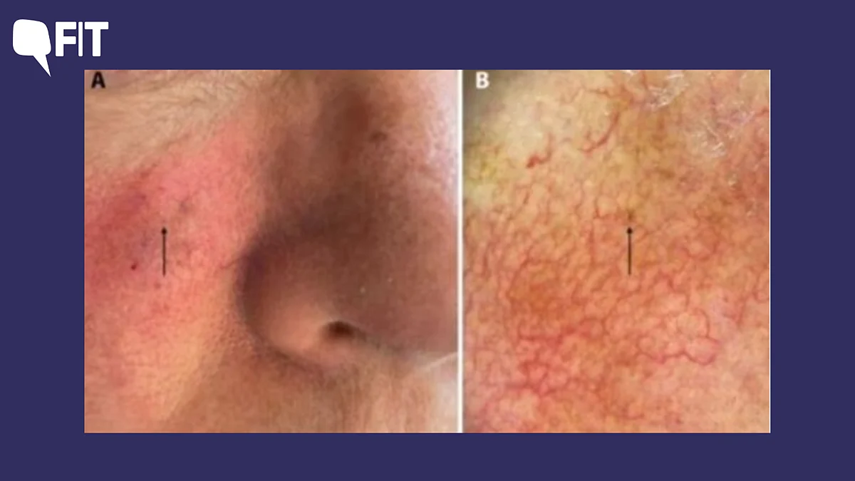 Worlds Smallest Skin Cancer Detected What We Know